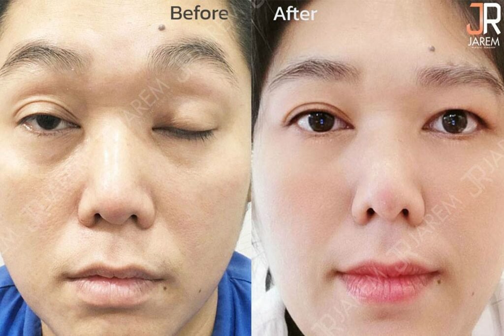 รักษากล้ามเนื้อตาอ่อนแรงแต่กำเนิด ด้วยการ “ร้อยเอ็นเทียม” - Jarem Clinic