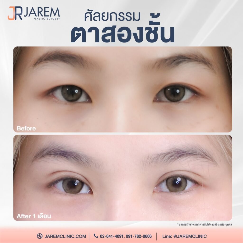 PROMOTION ดวงตา และใบหน้า - Jarem Clinic